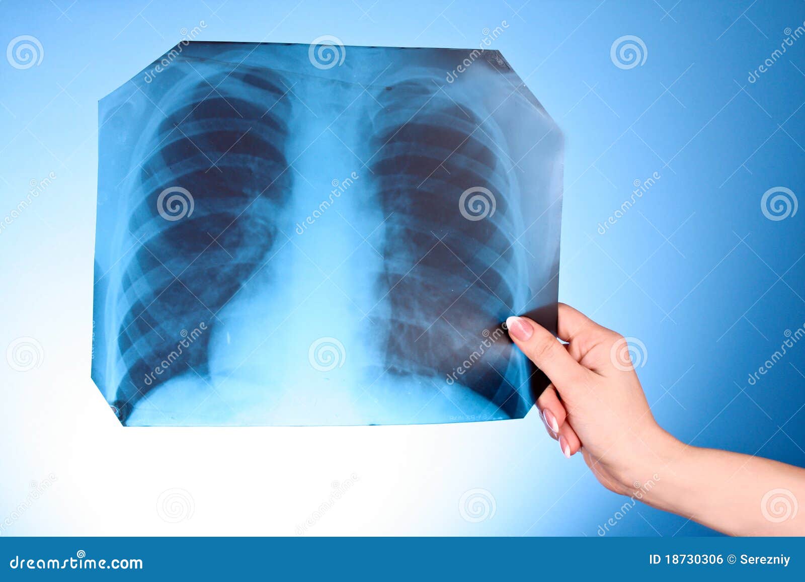 X-Ray Image of Chest on Blue Background Stock Photo - Image of ...