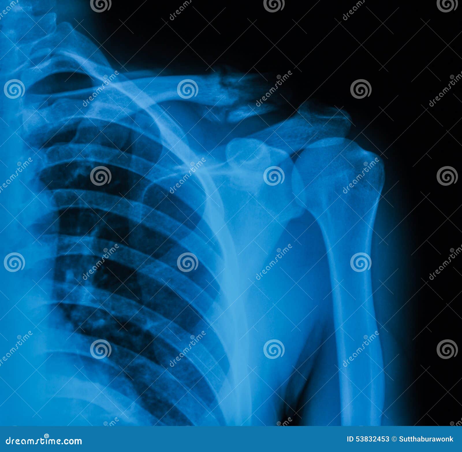 X-ray Image of Clavicle, AP View Stock Image - Image of black, accident ...