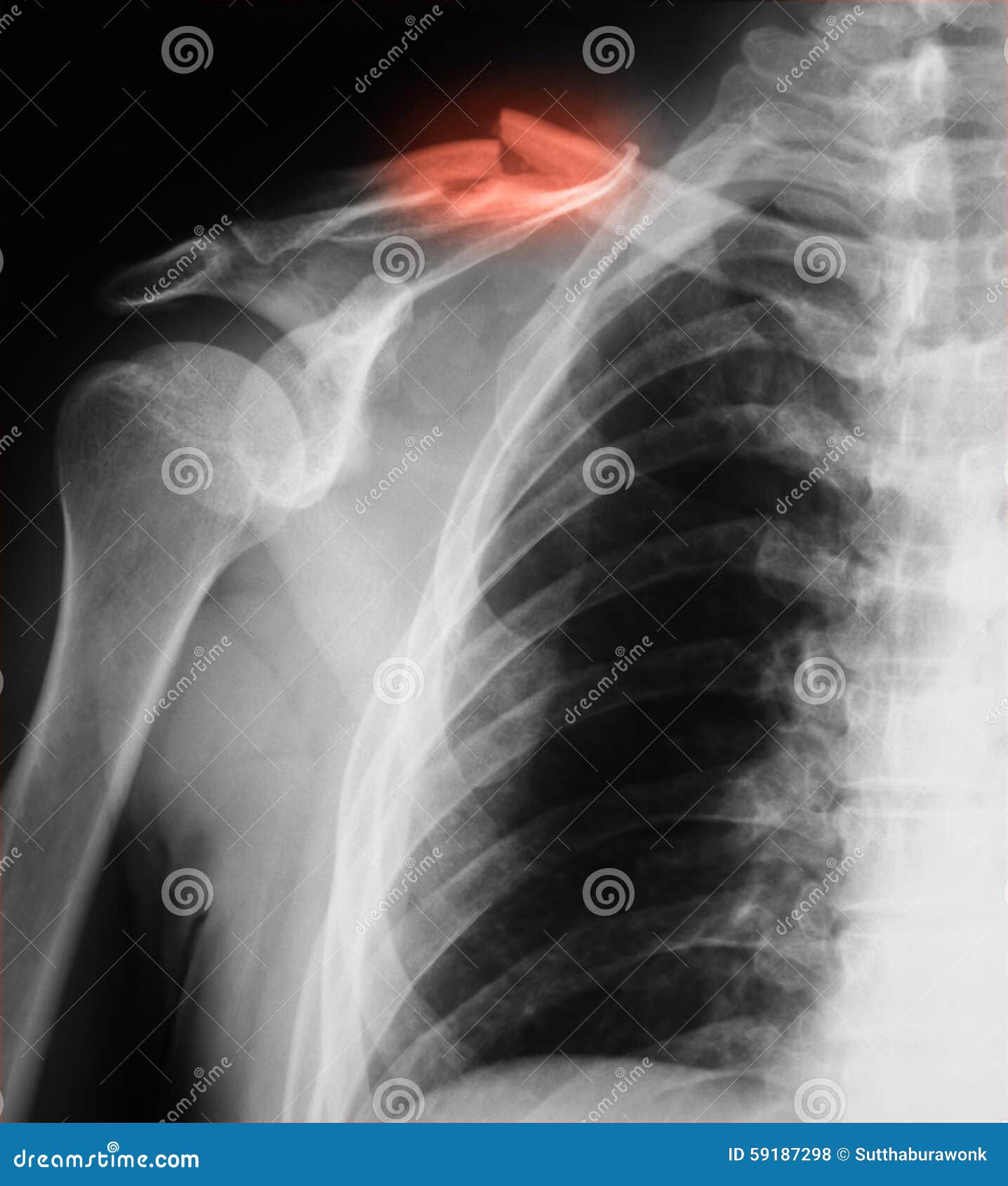 X-ray Image of Clavicle, AP View. Stock Photo - Image of exam, lung ...