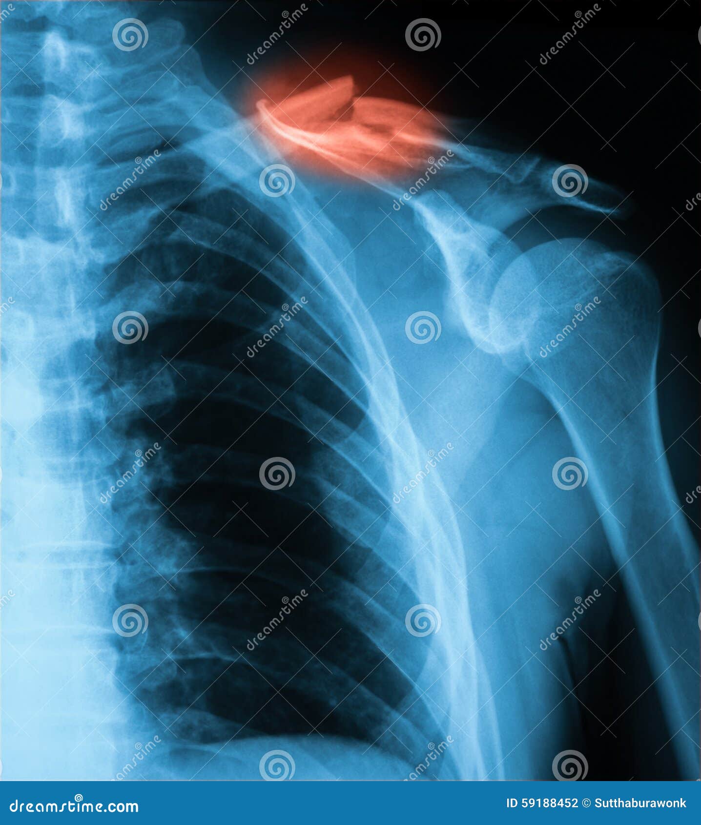 X-ray Image of Clavicle, AP View. Stock Photo - Image of room, lung ...