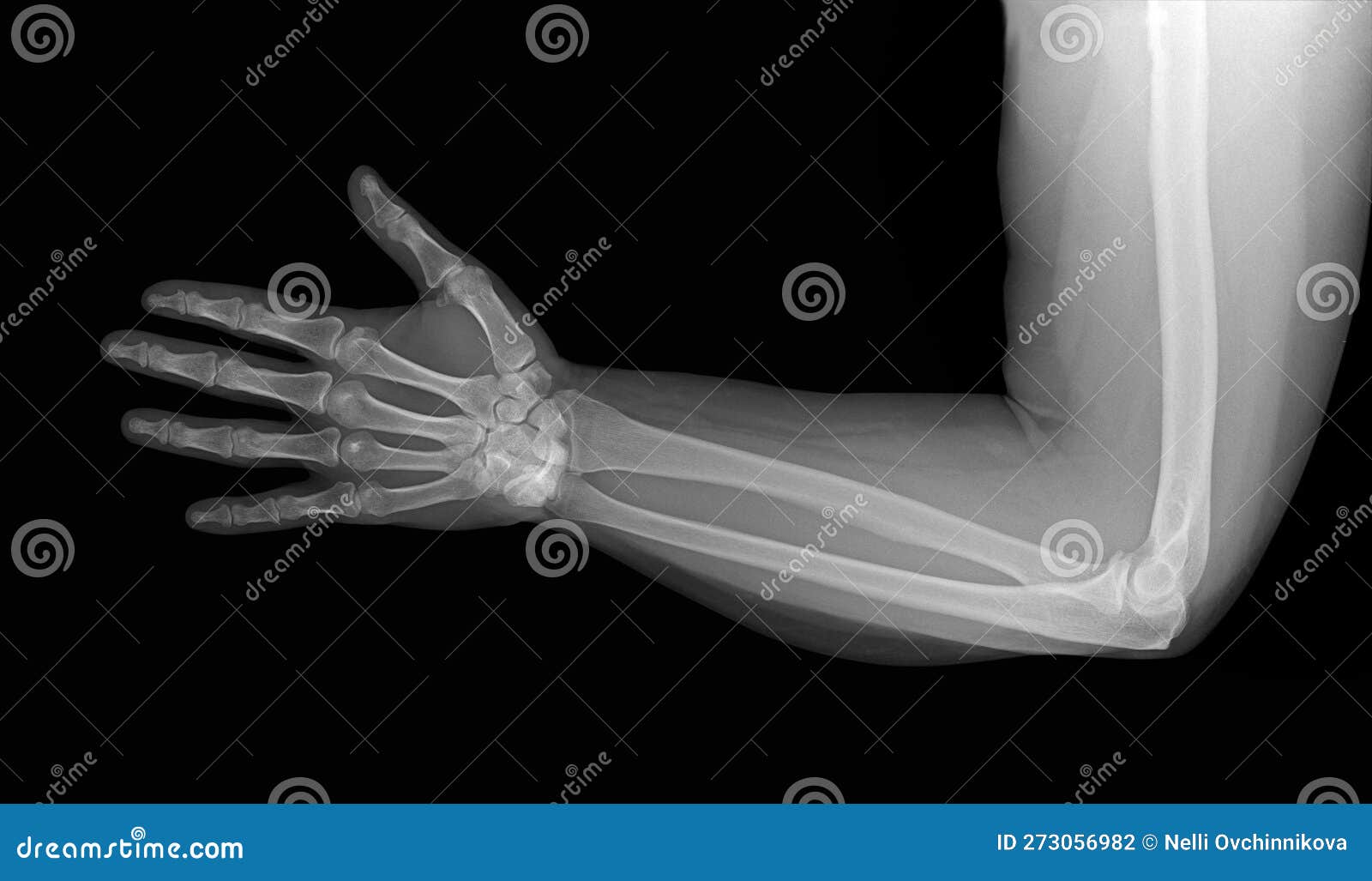 X-ray Image of the Elbow Joint, without Visible Traumatic and Bone ...