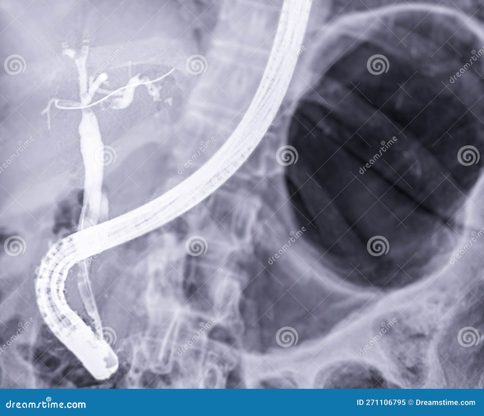 X-ray Image of Endoscopic after Doctor Doing ERCP and Laparoscopic ...