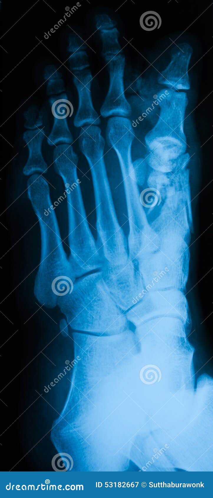 X-ray Image of Foot, AP View. Stock Image - Image of talus, scan: 53182667
