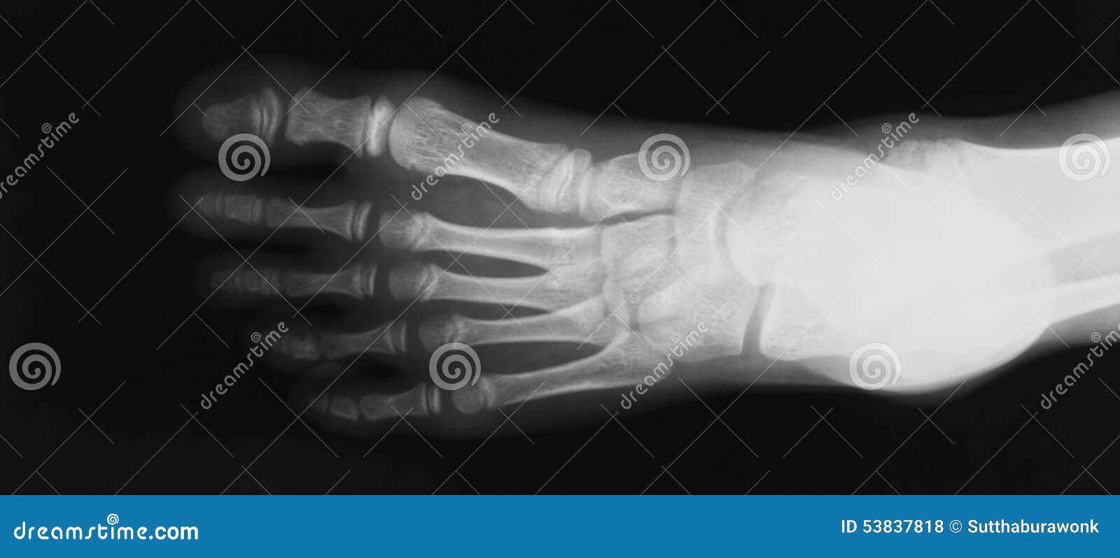 X-ray Image of Foot AP View. Stock Photo - Image of ankle, doctor: 53837818