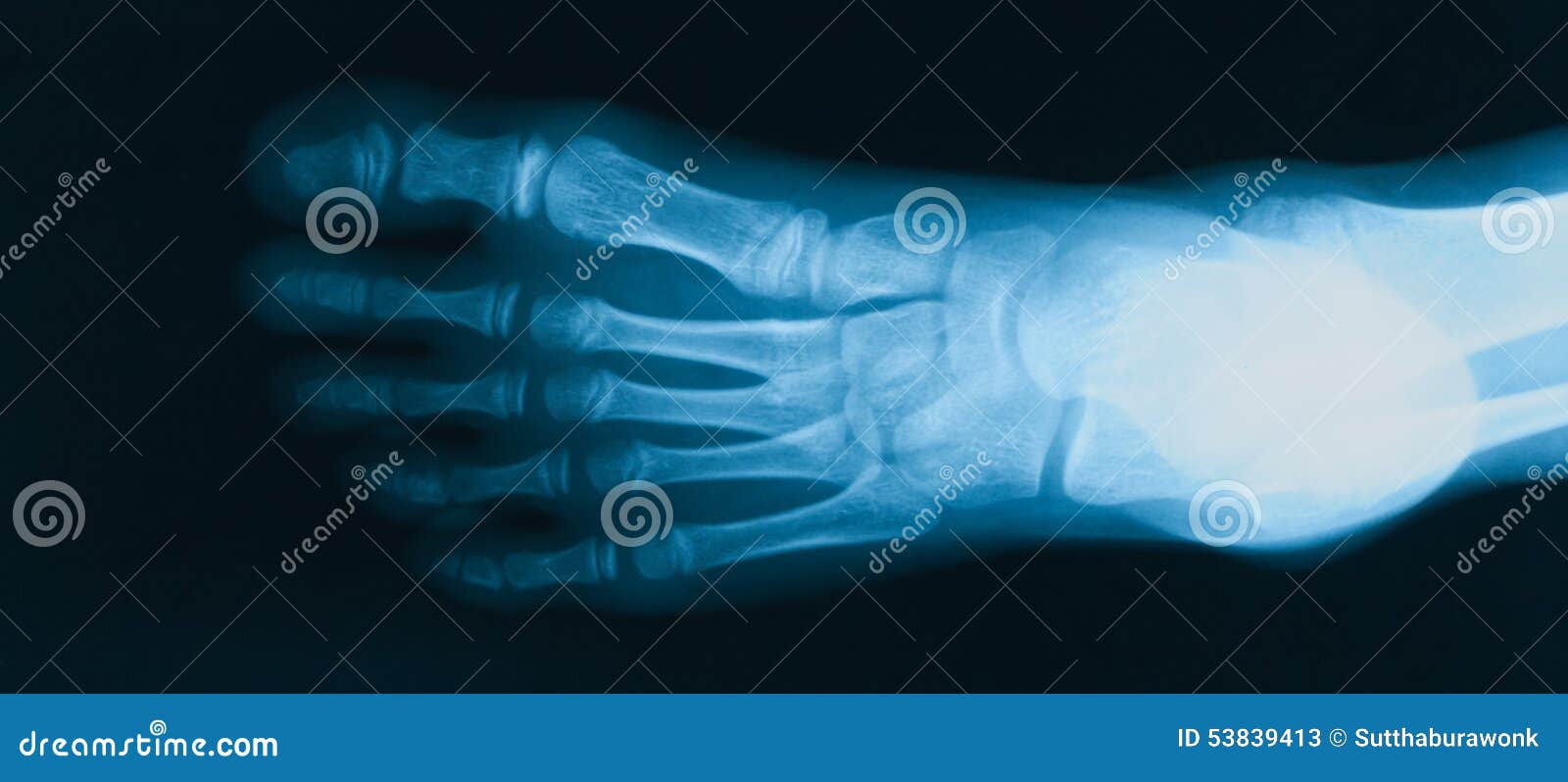 X-ray Image of Foot, AP View. Stock Image - Image of patient, examining ...