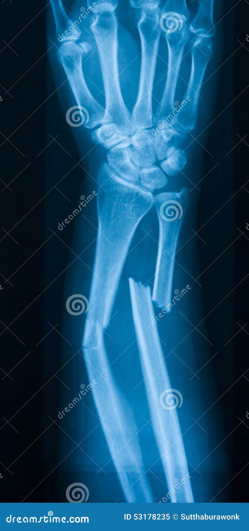 X Ray Image Of Forearm Ap View Antero Posterior View Show Fracture Of Ulna And Radius Stock