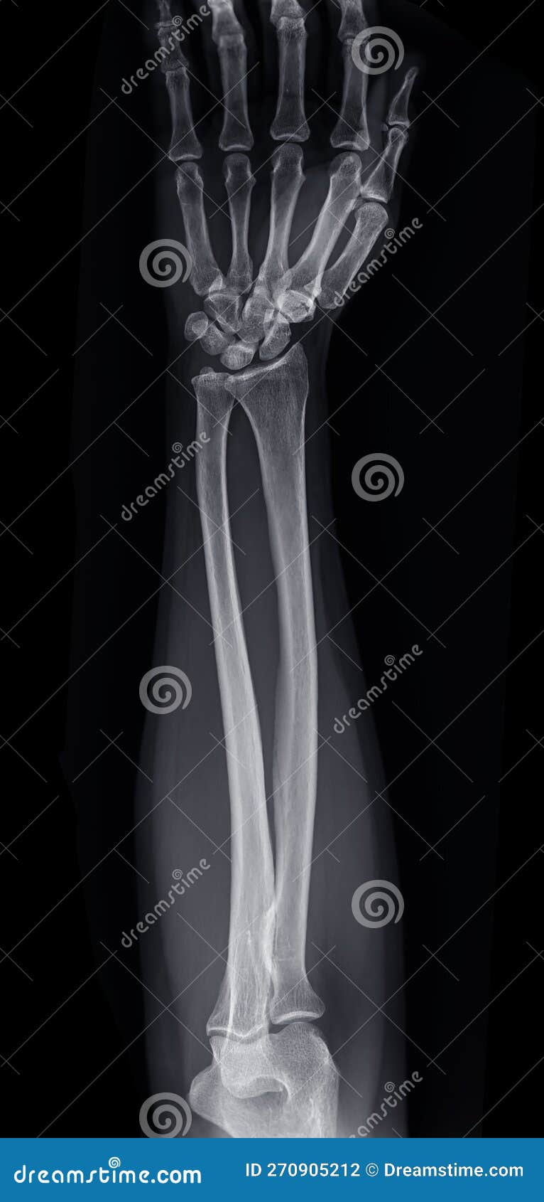 X-ray Image Of Forearm,lateral View, Show Fracture Of Ulna And R ...