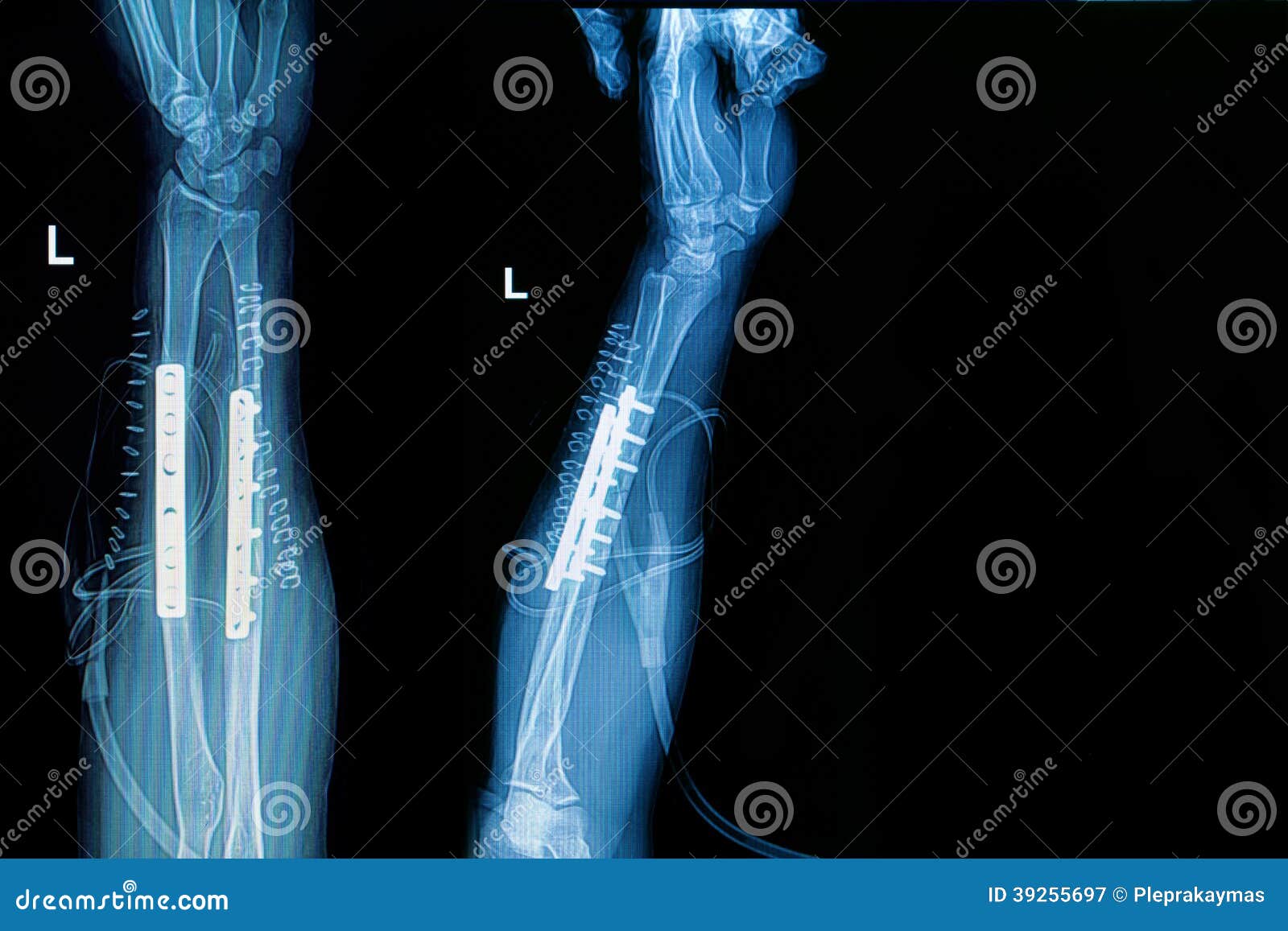 X-ray Image Of Forearm, AP View (Antero-posterior View, Show Fracture ...