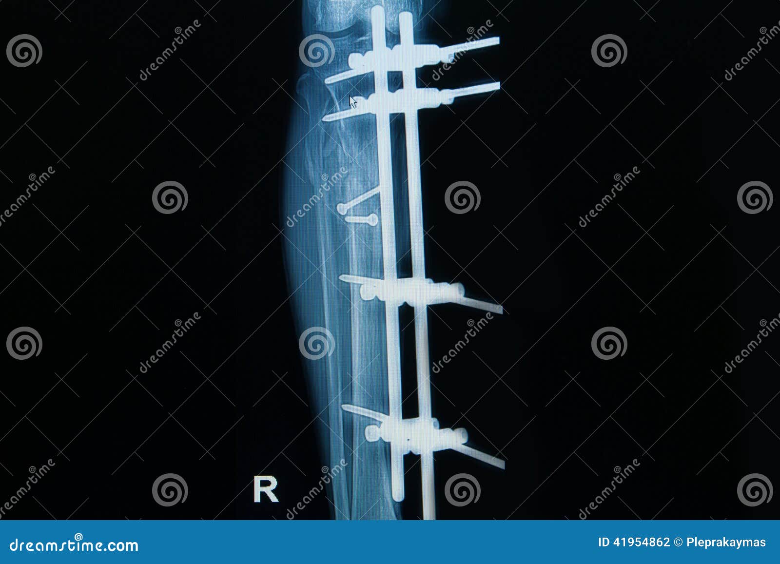 Tibia X-ray Picture Royalty-Free Stock Image | CartoonDealer.com #19208884