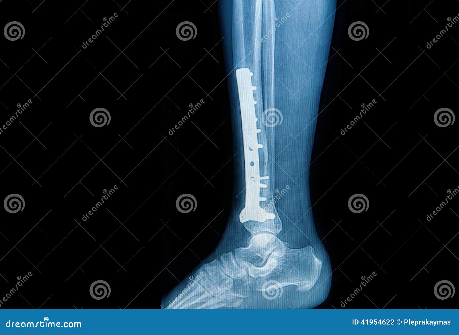 X-ray Image Of Fracture Leg With Implant External Fixation. Stock ...