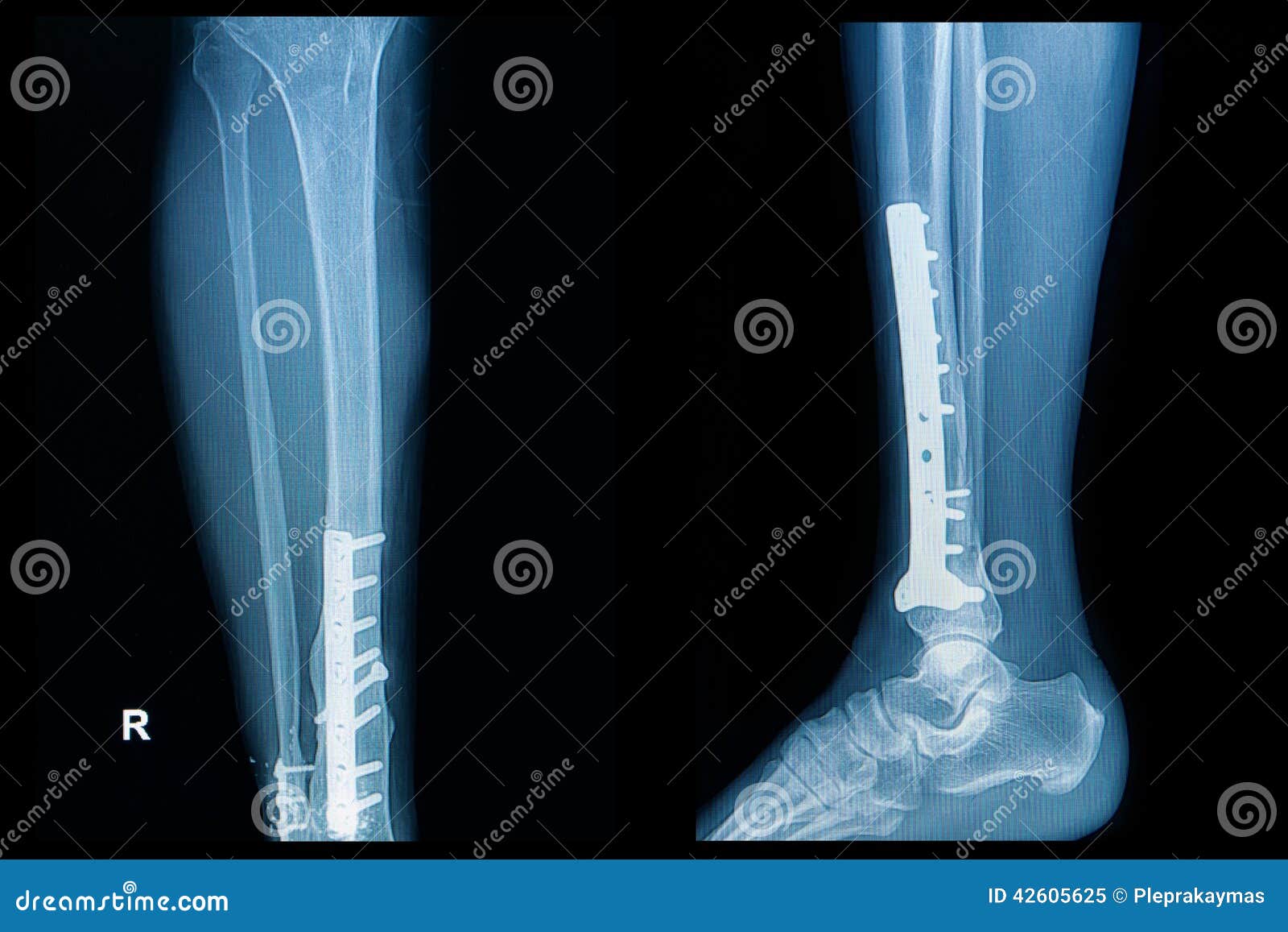 X-ray Image of Fracture Leg (tibia )with Implant Plate Stock Image ...