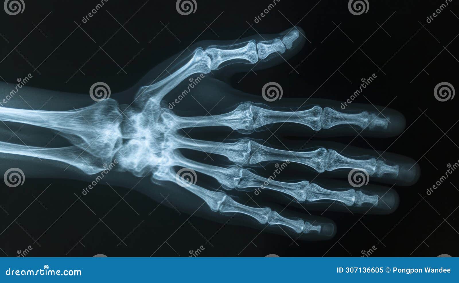 X-Ray Image of Hand Bones and Joints in High Resolution Stock ...