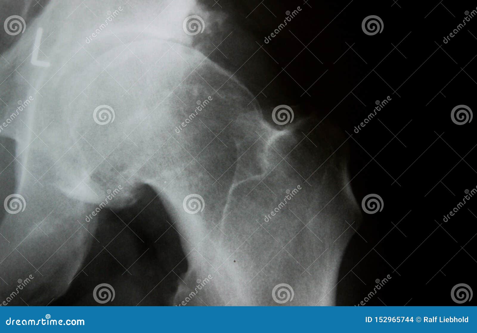 X-Ray Image of Hip Bone with Degeneration of the Joint Coxarthrosis ...