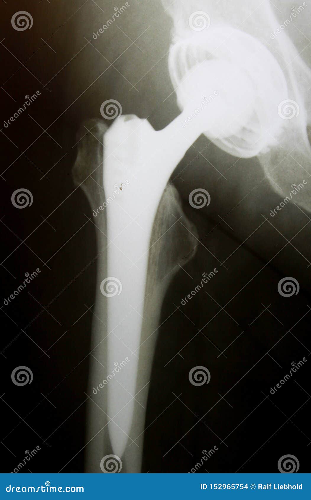 X-Ray Image of Hip with Implanted Artificial Joint Replacement ...