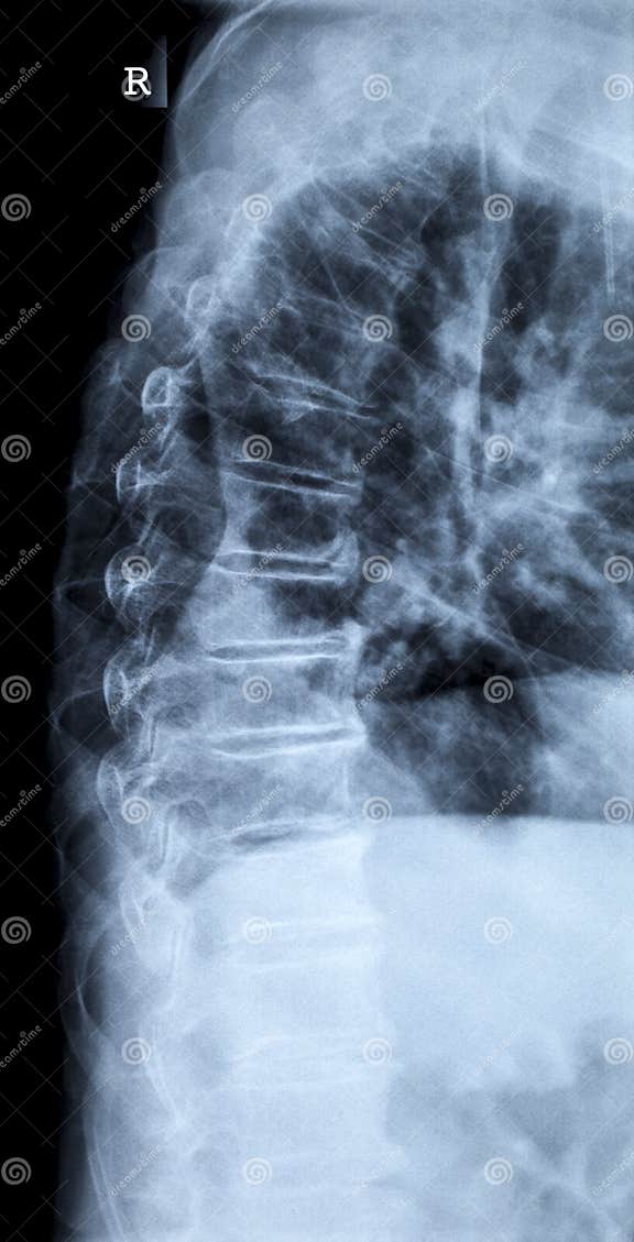 X-ray Image of a Human Adult Backbone Stock Photo - Image of anatomy ...