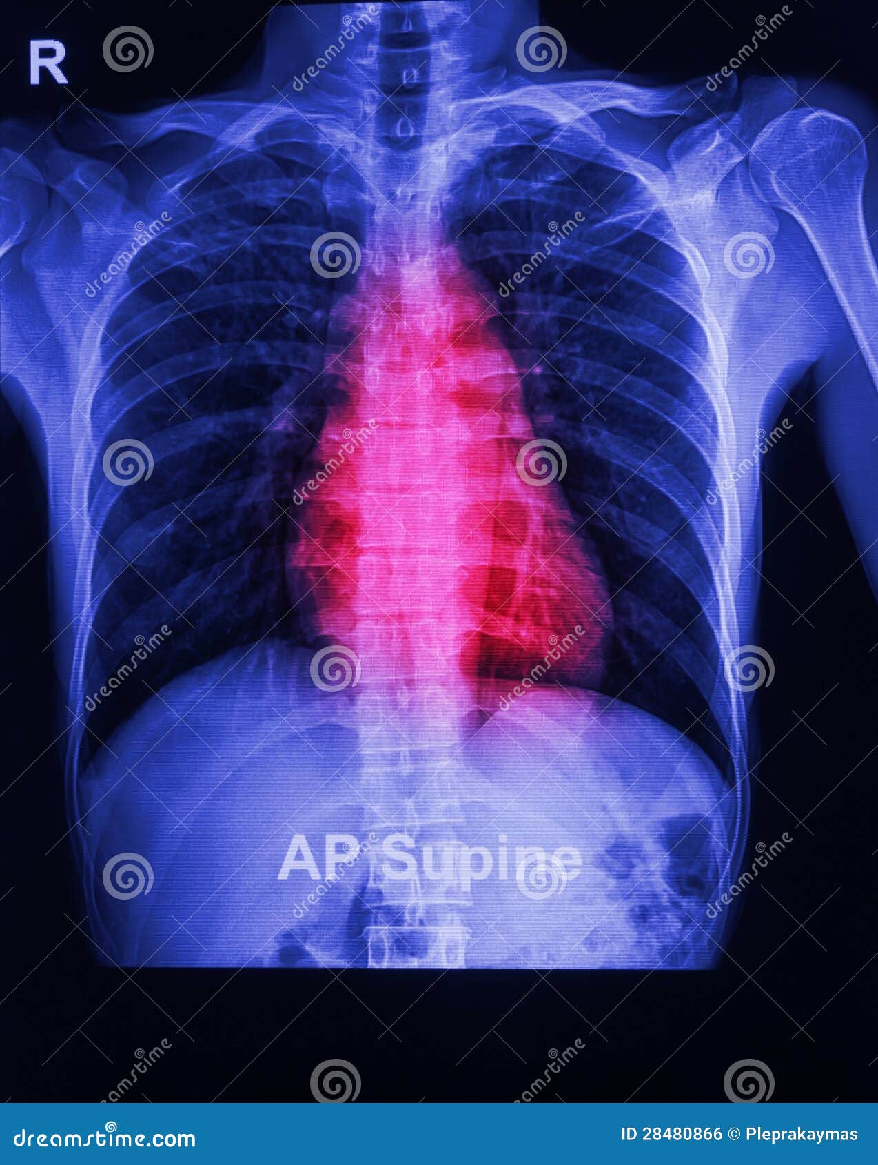 The X-ray Image of a Human Chest Stock Photo - Image of cage, profile ...