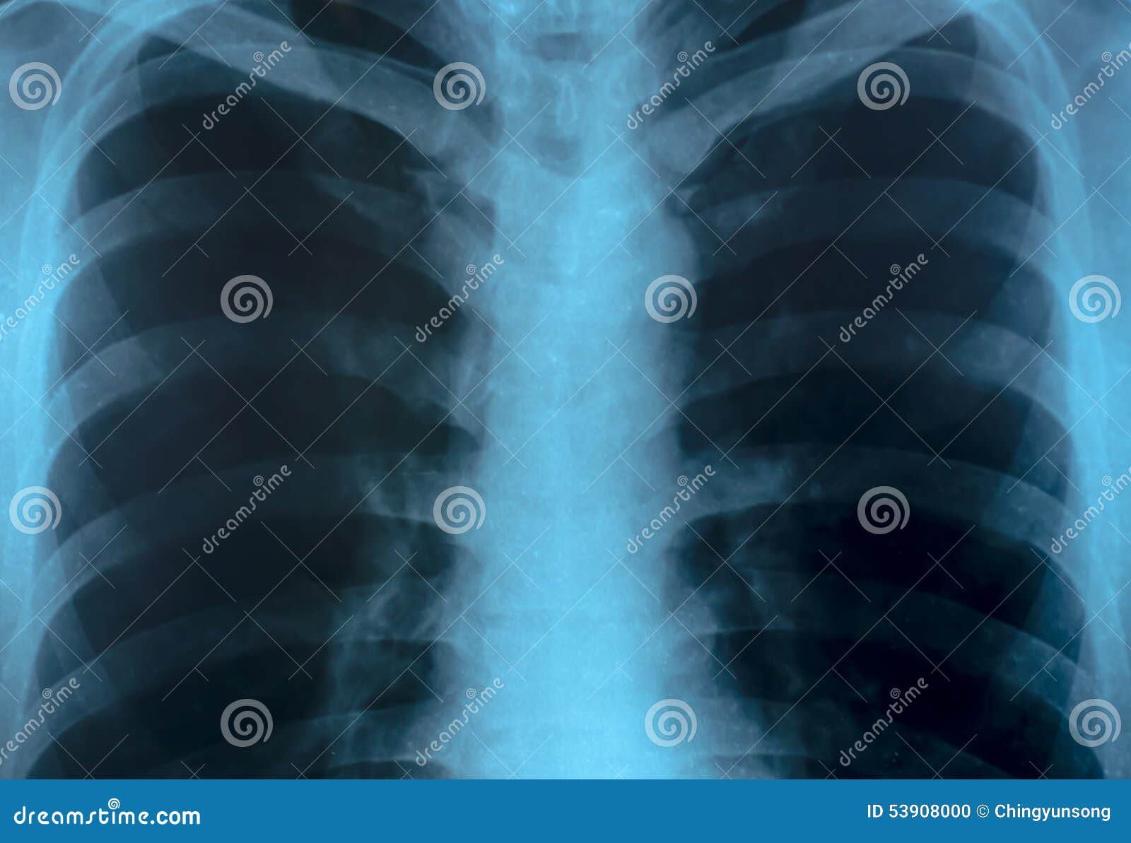 X-Ray Image of Human Chest stock photo. Image of lung - 53908000