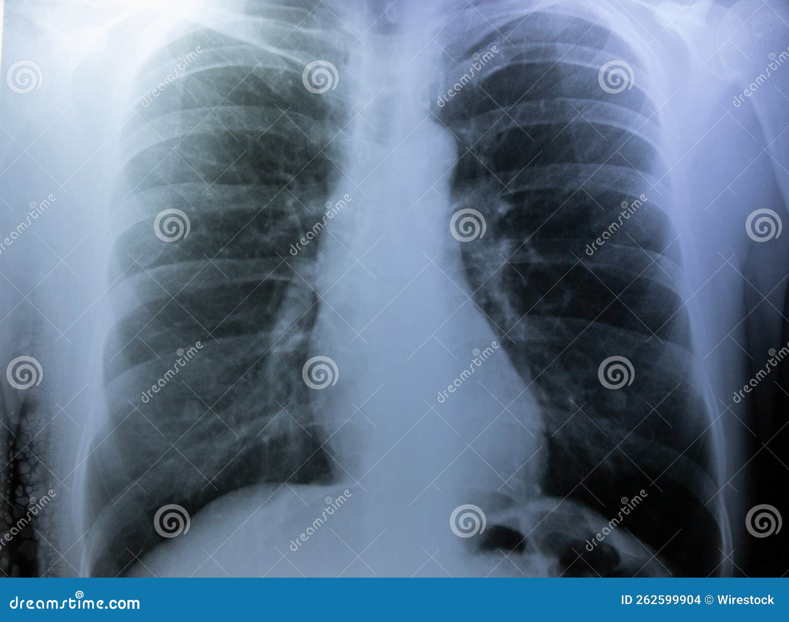 X Ray Image of a Human Chest Stock Photo - Image of exam, health: 262599904