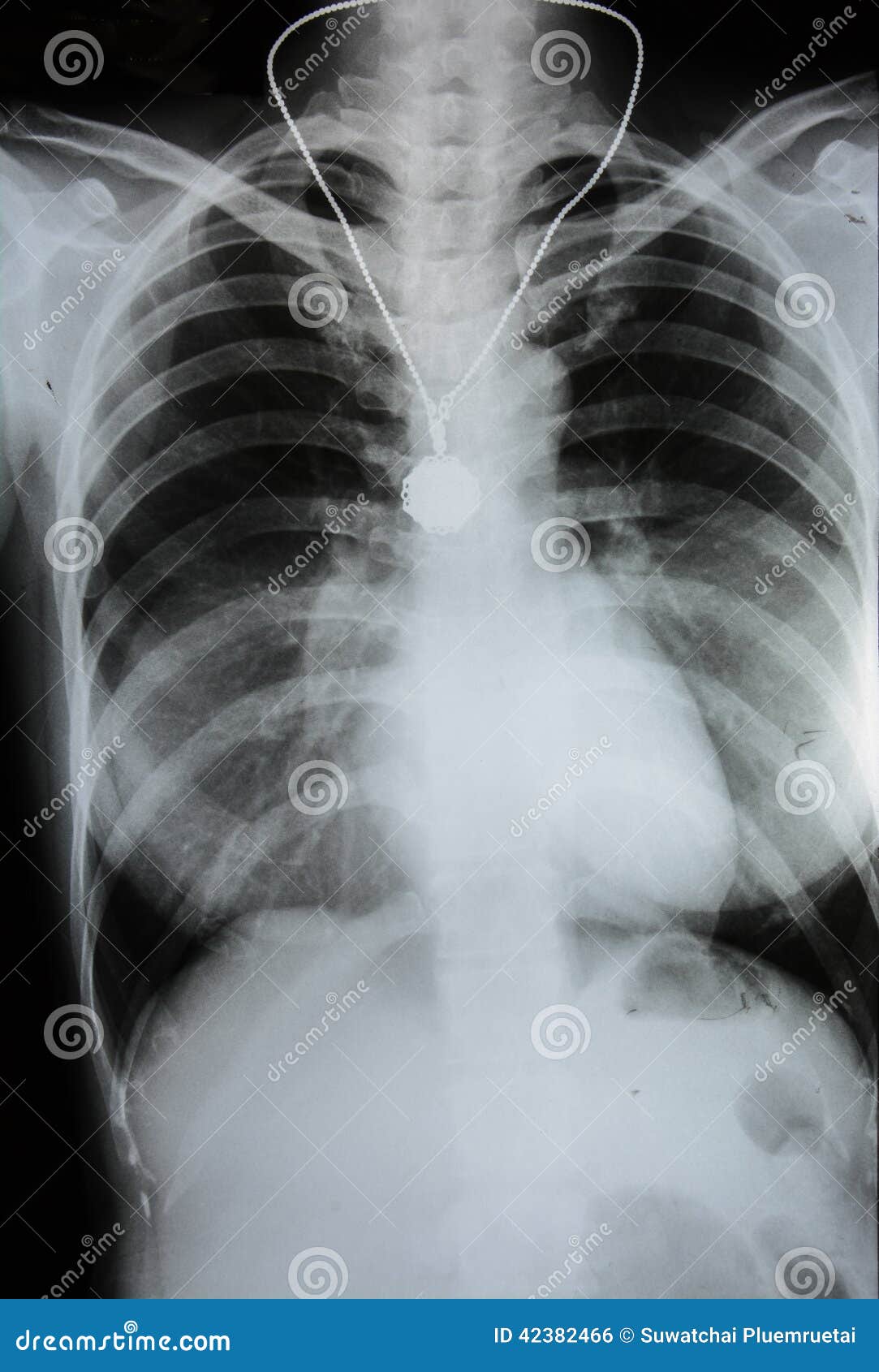 X-Ray Image of Human Chest stock photo. Image of abdominal - 42382466
