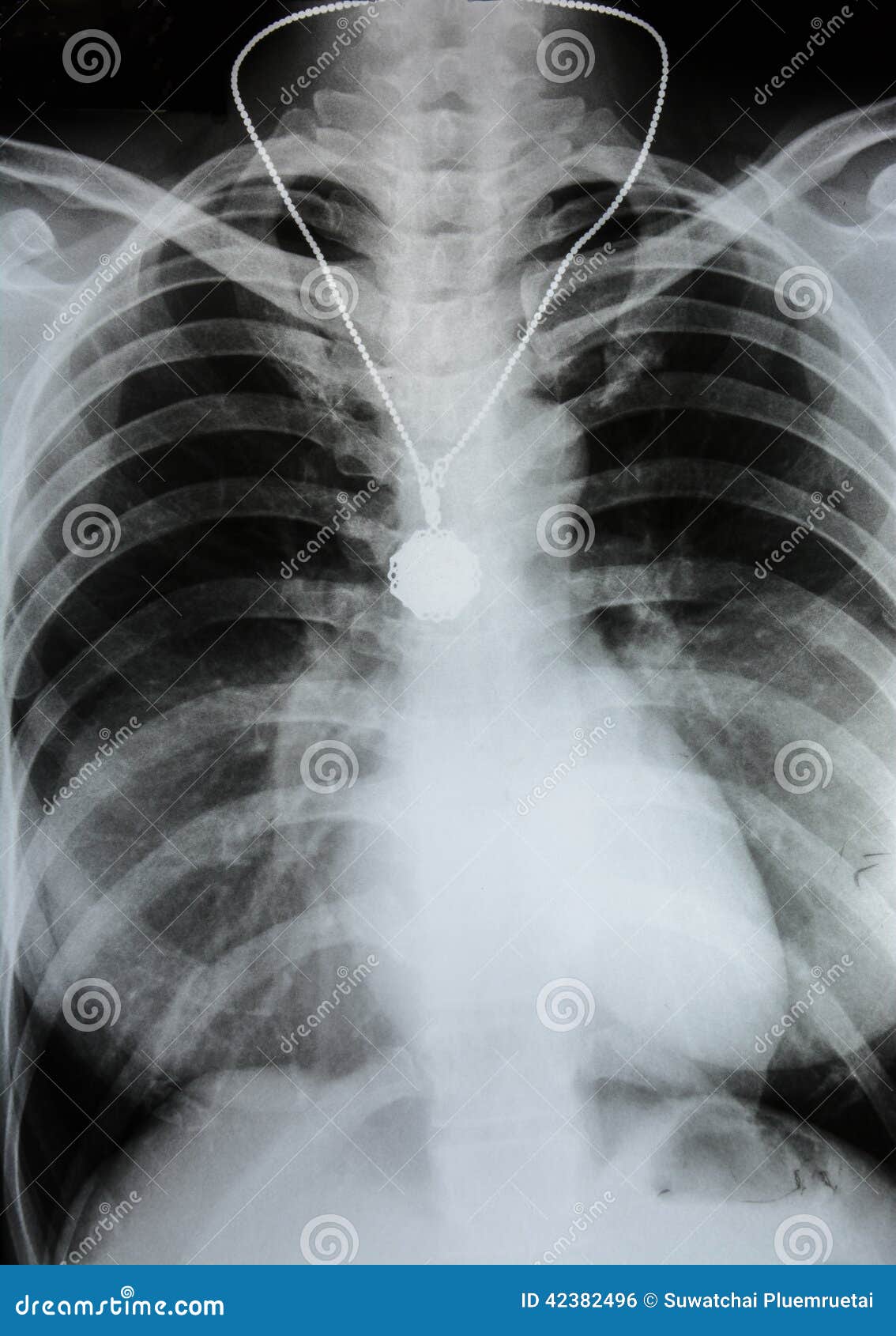 X-Ray Image of Human Chest stock photo. Image of body - 42382496