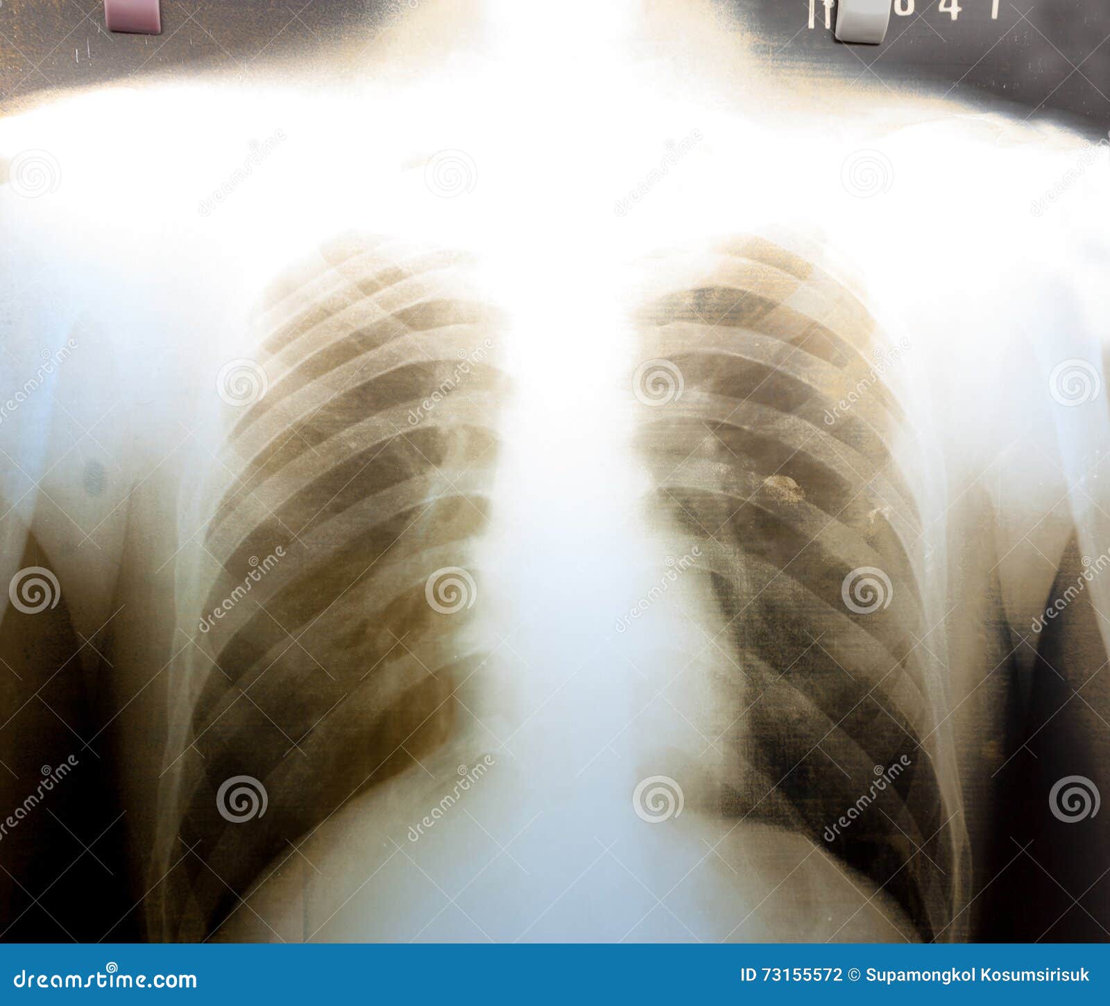 Chest Medical Xray, Lungs And Heart View Royalty-Free Stock Image ...