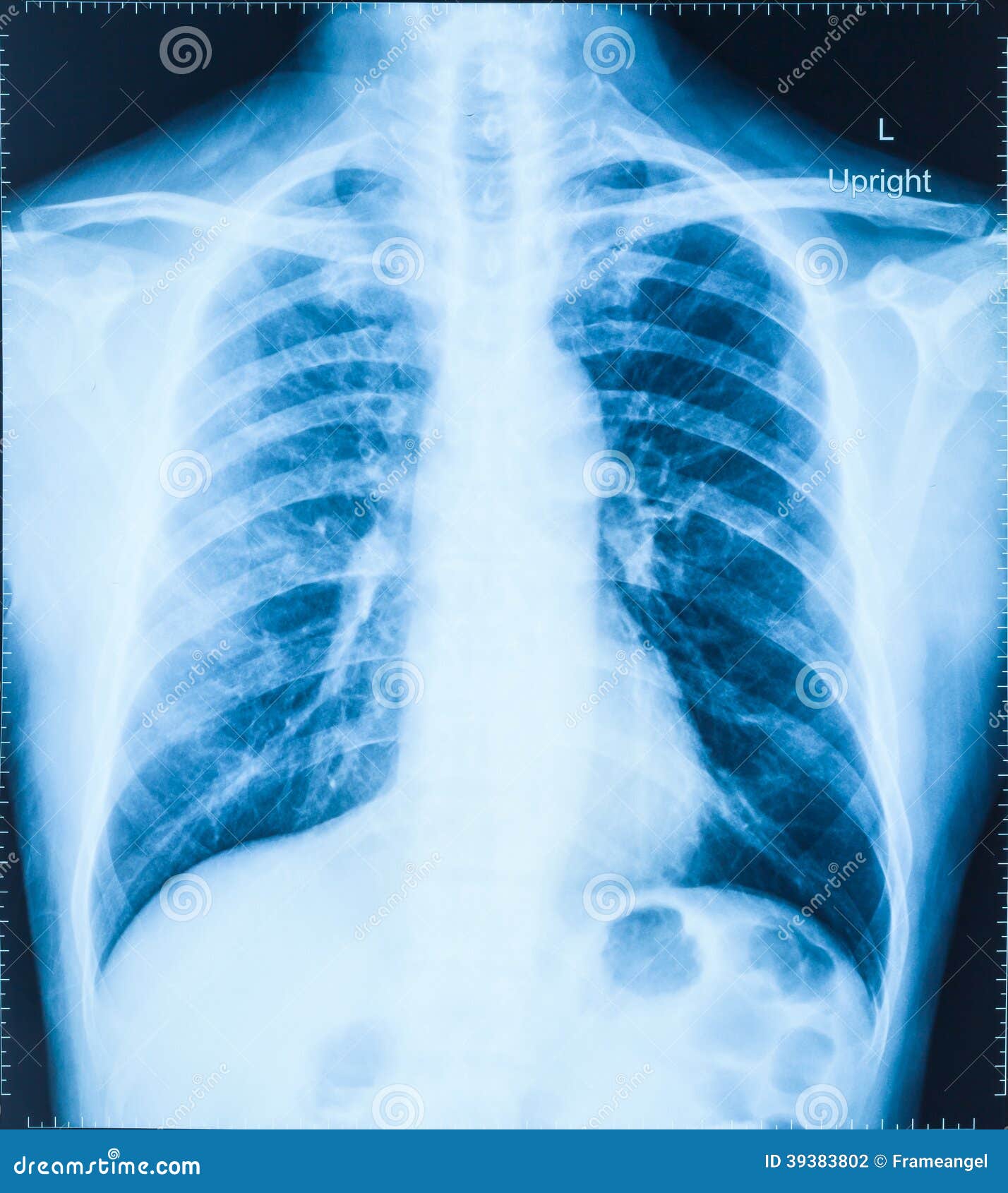 X-Ray Image of Human Chest stock photo. Image of hospital - 39383802