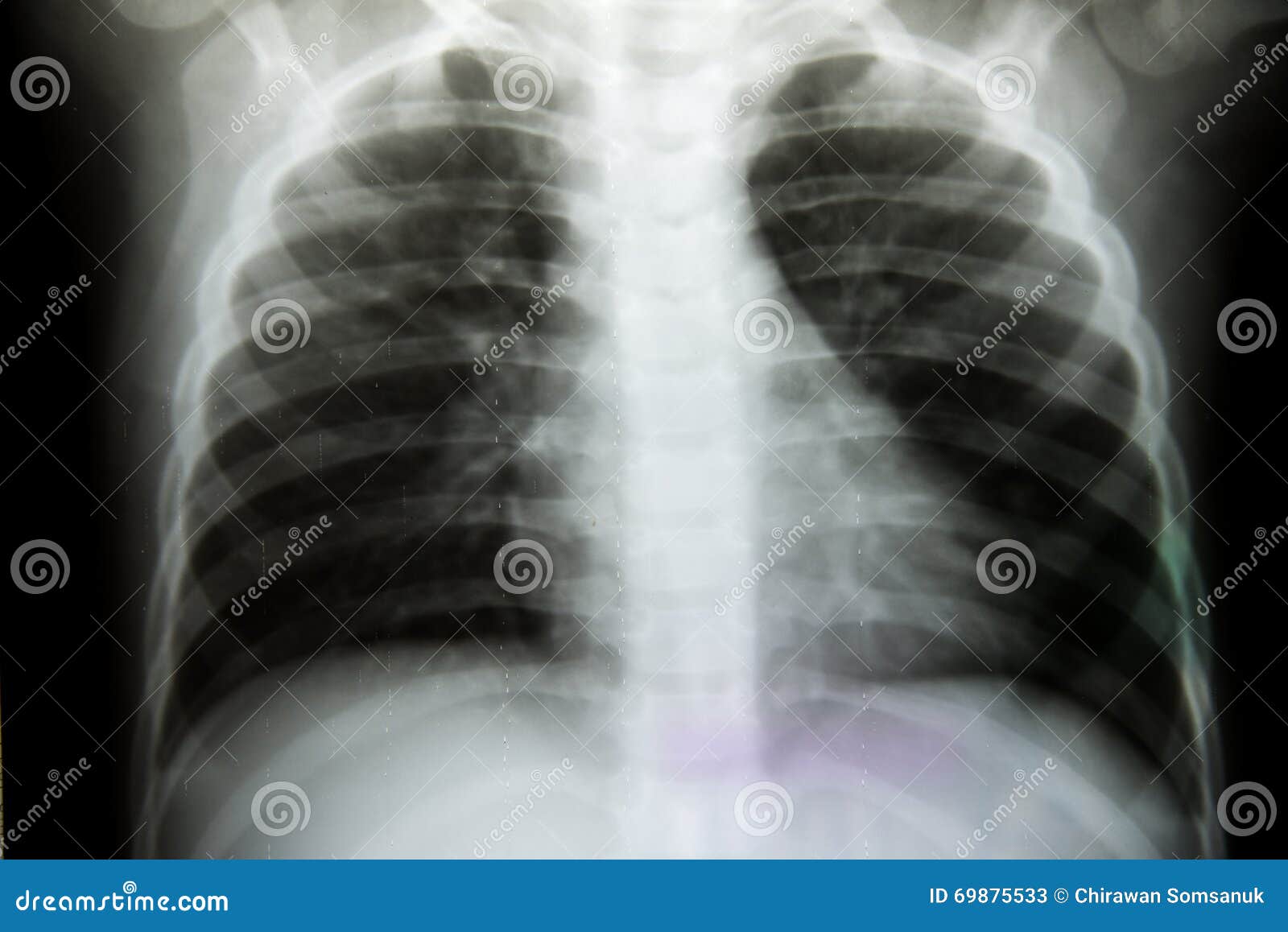 X-Ray Image of Human Chest stock image. Image of diagnostic - 69875533