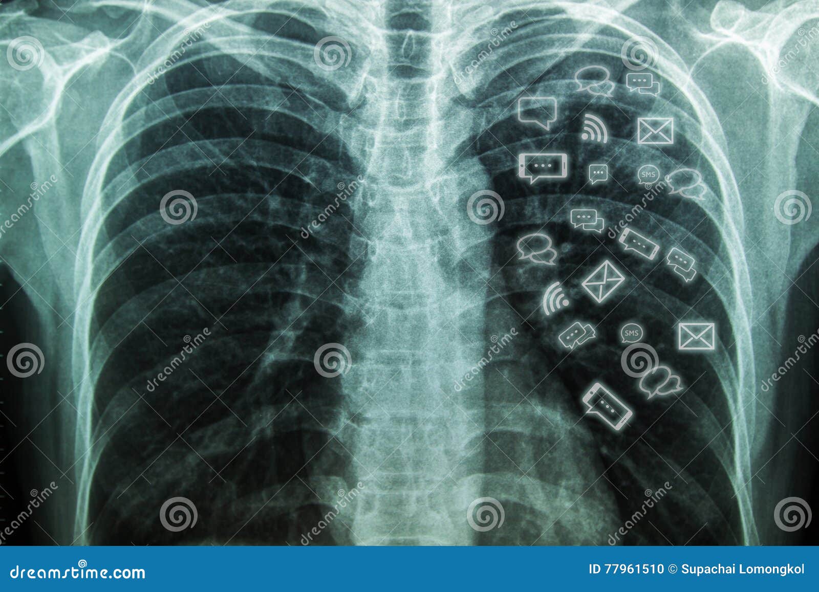 X-ray Of The Human Chest, The Concept Of Preventive Examination ...