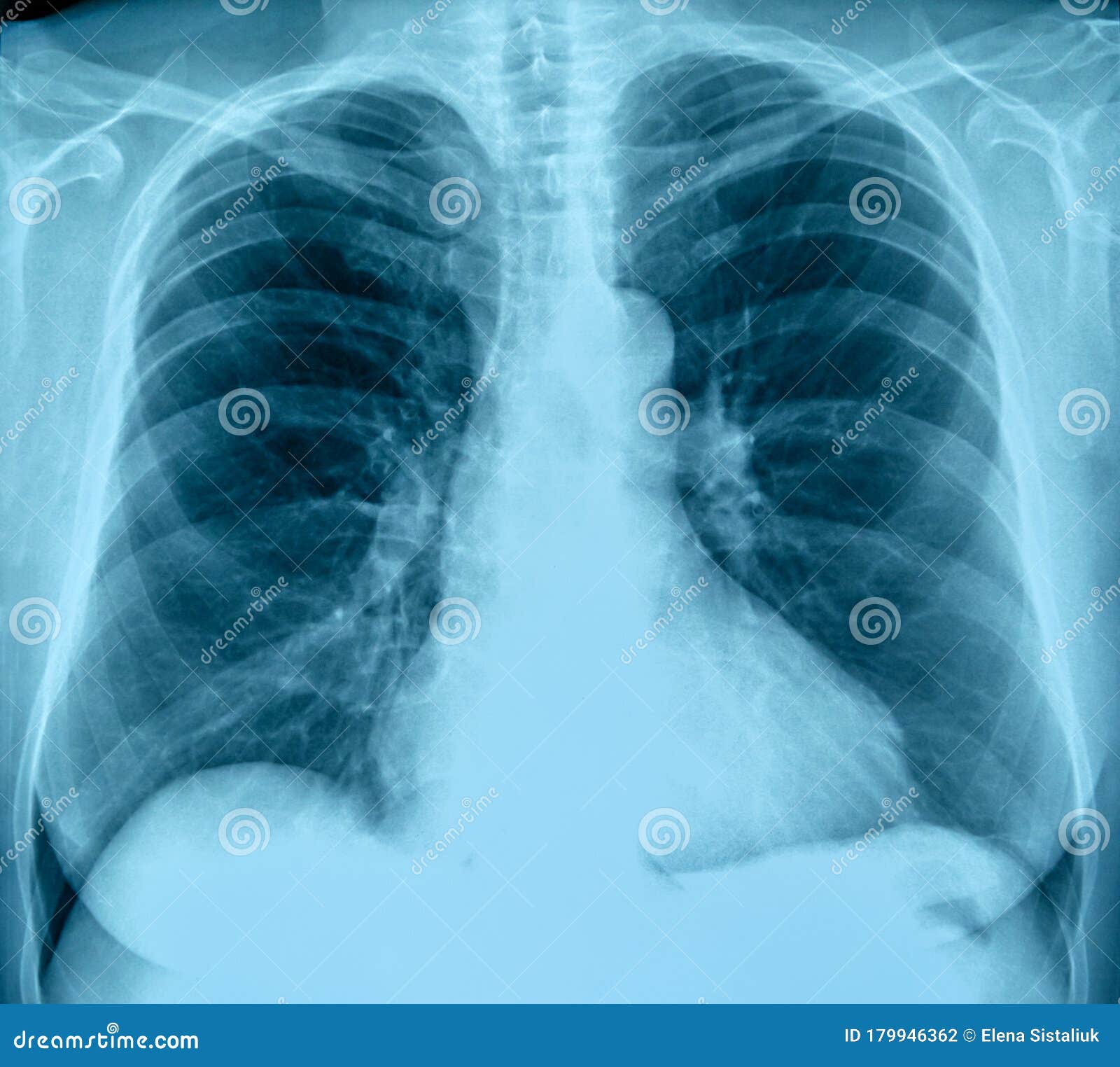 X-Ray Image of Human Chest stock photo. Image of heart - 179946362