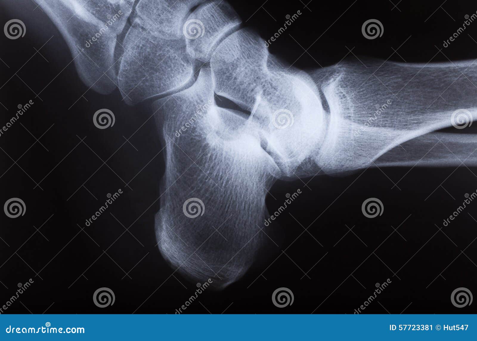 X-ray Image of Human Foot Joint , Side View Stock Image - Image of ...