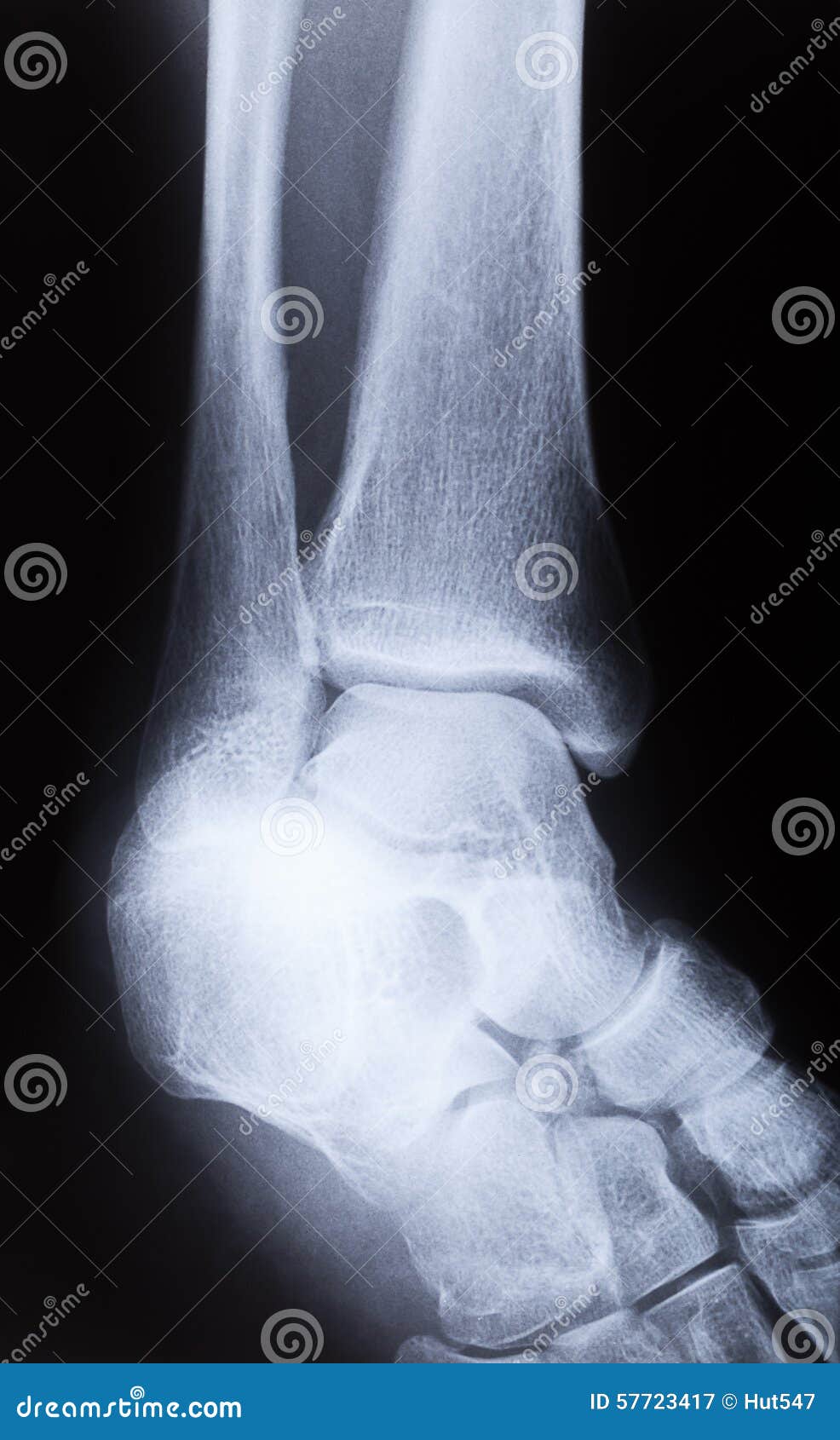 X-ray Image of Human Foot Joint , Side View Stock Image - Image of ...