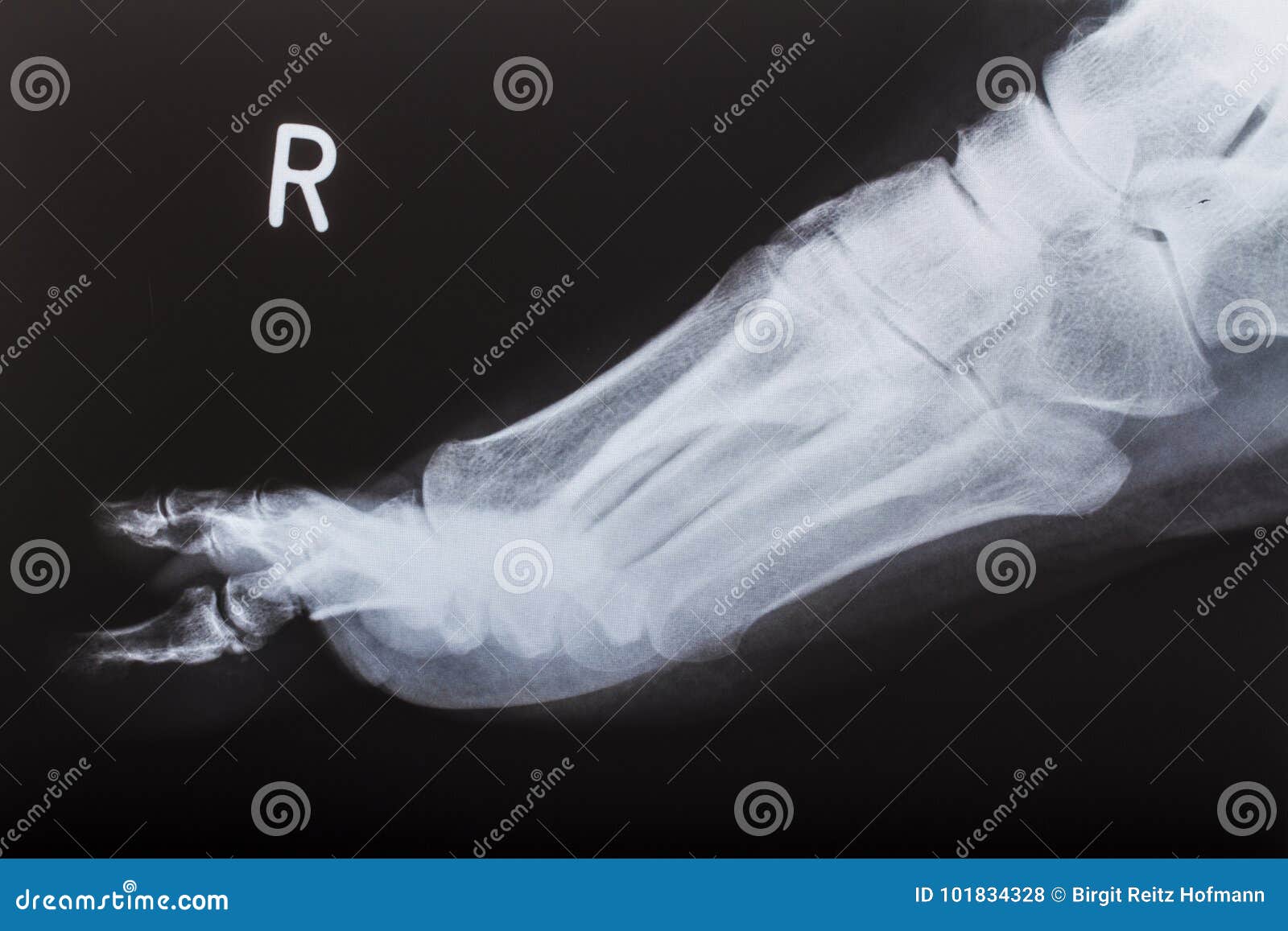 X-ray image of human foot stock photo. Image of anatomy - 101834328
