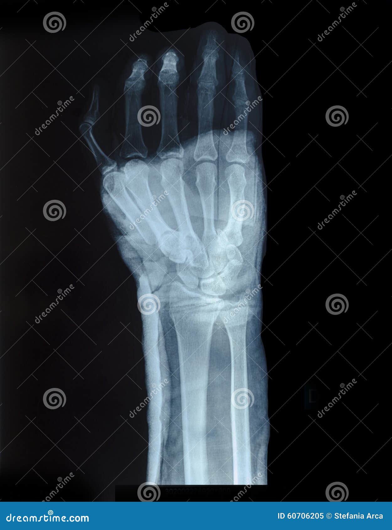 X-Ray image of human hand stock image. Image of health - 60706205