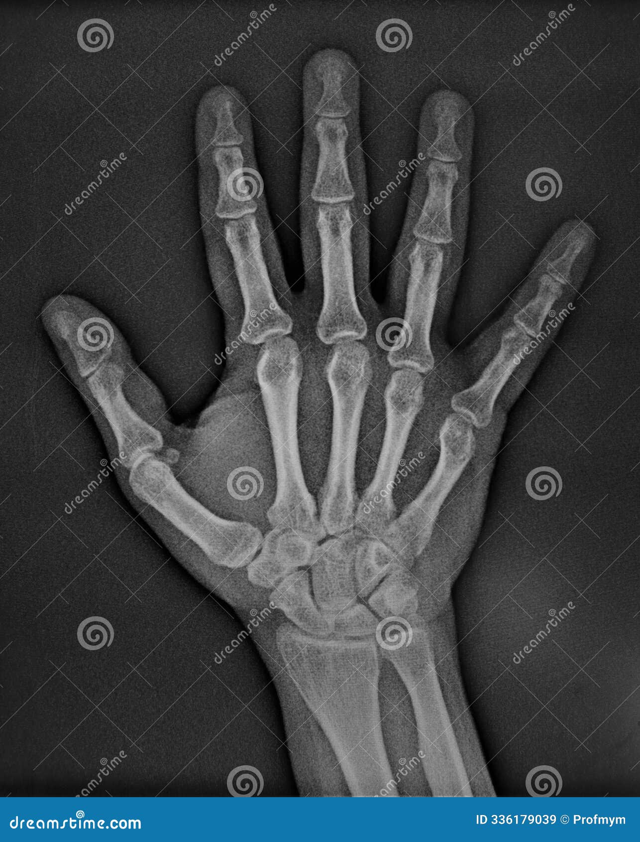 X-ray Image of a Human Hand. Right Hand is Intact and Has No Injury ...