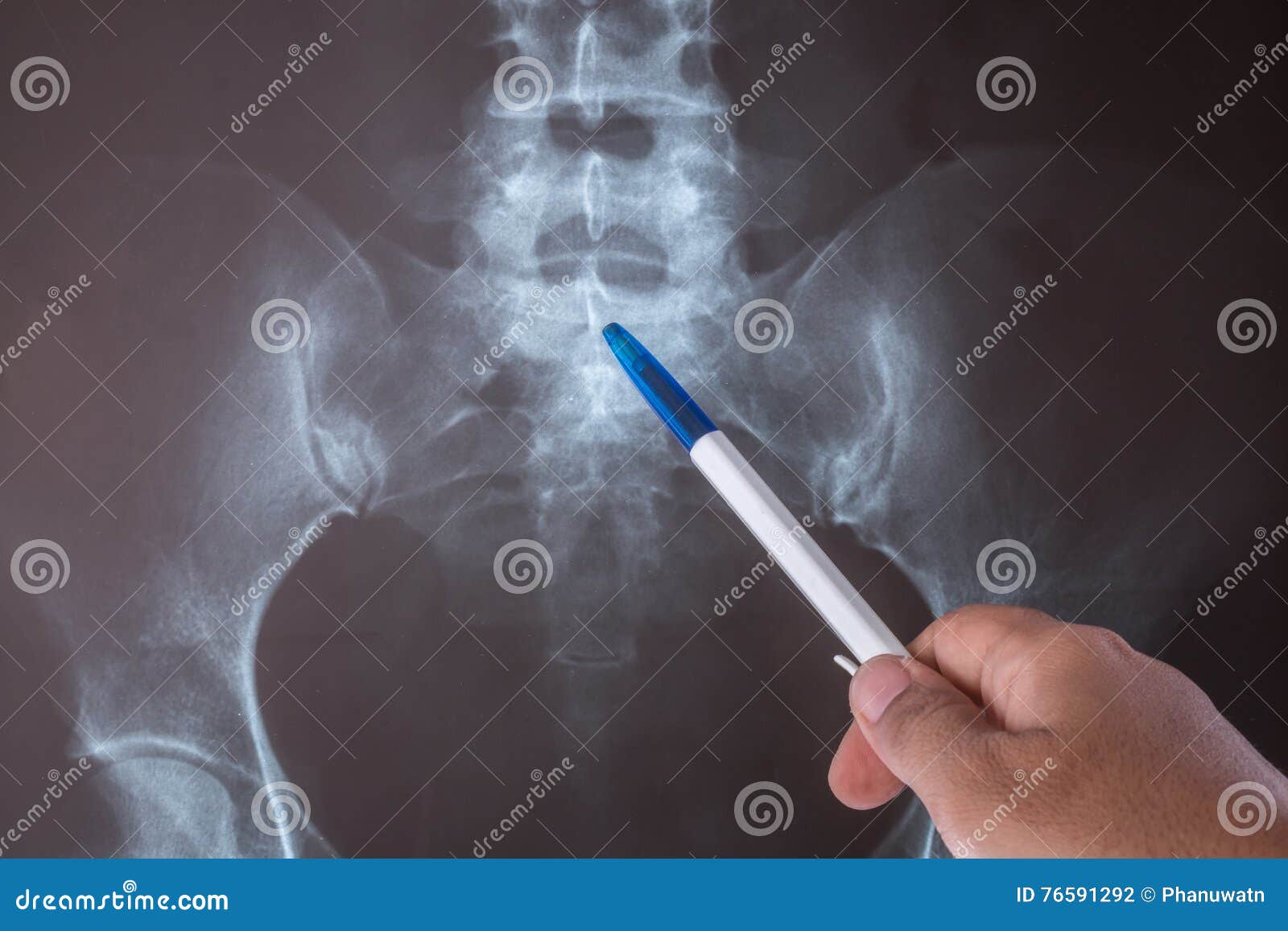 X-Ray Image Of Human For A Medical Diagnosis Stock Photo - Image of ...