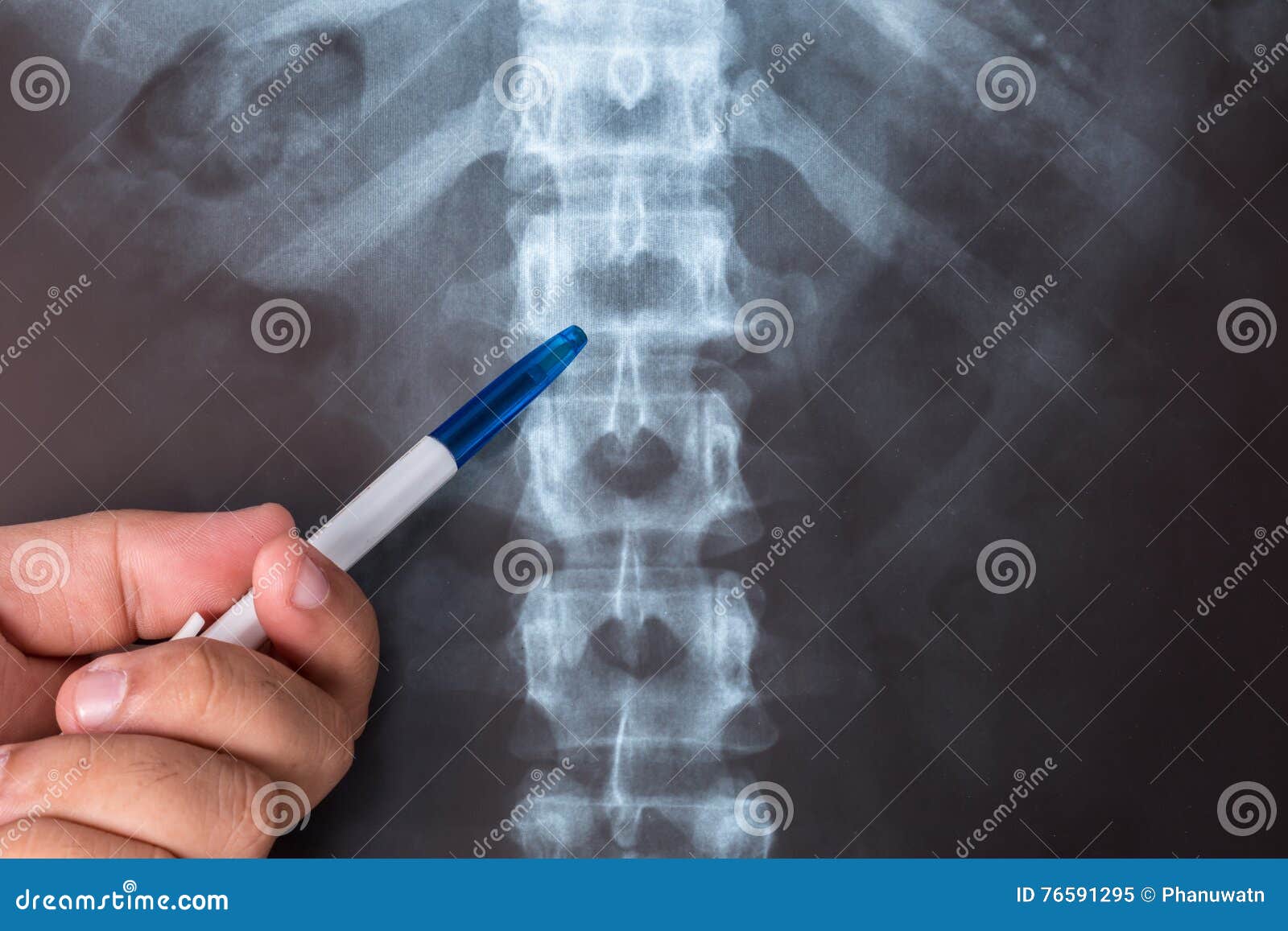 X-Ray Image of Human for a Medical Diagnosis Stock Image - Image of ...