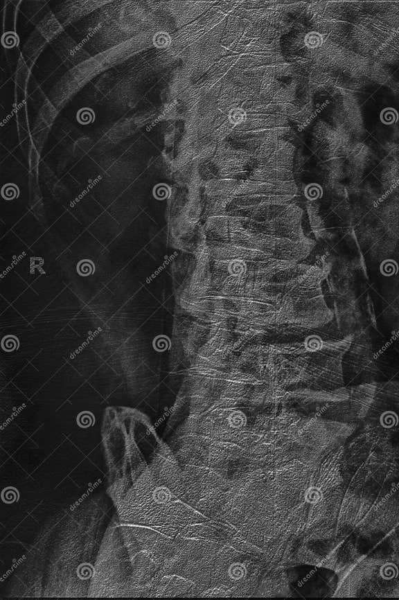 Backbone stock photo. Image of spine, radiologist, disease - 307452646