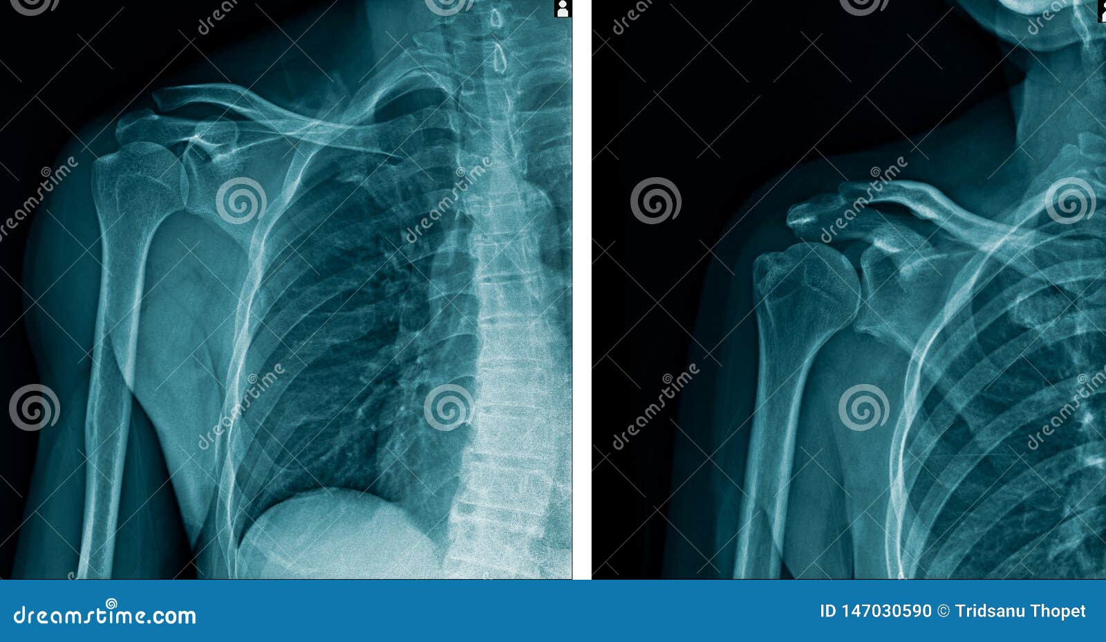X-ray image human shoulder stock photo. Image of cure - 147030590