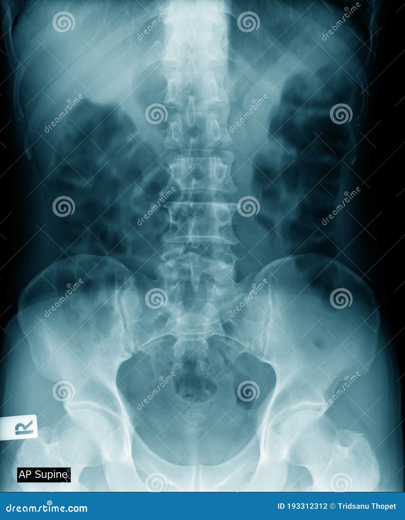 X-ray image of human spine stock photo. Image of doctor - 193312312