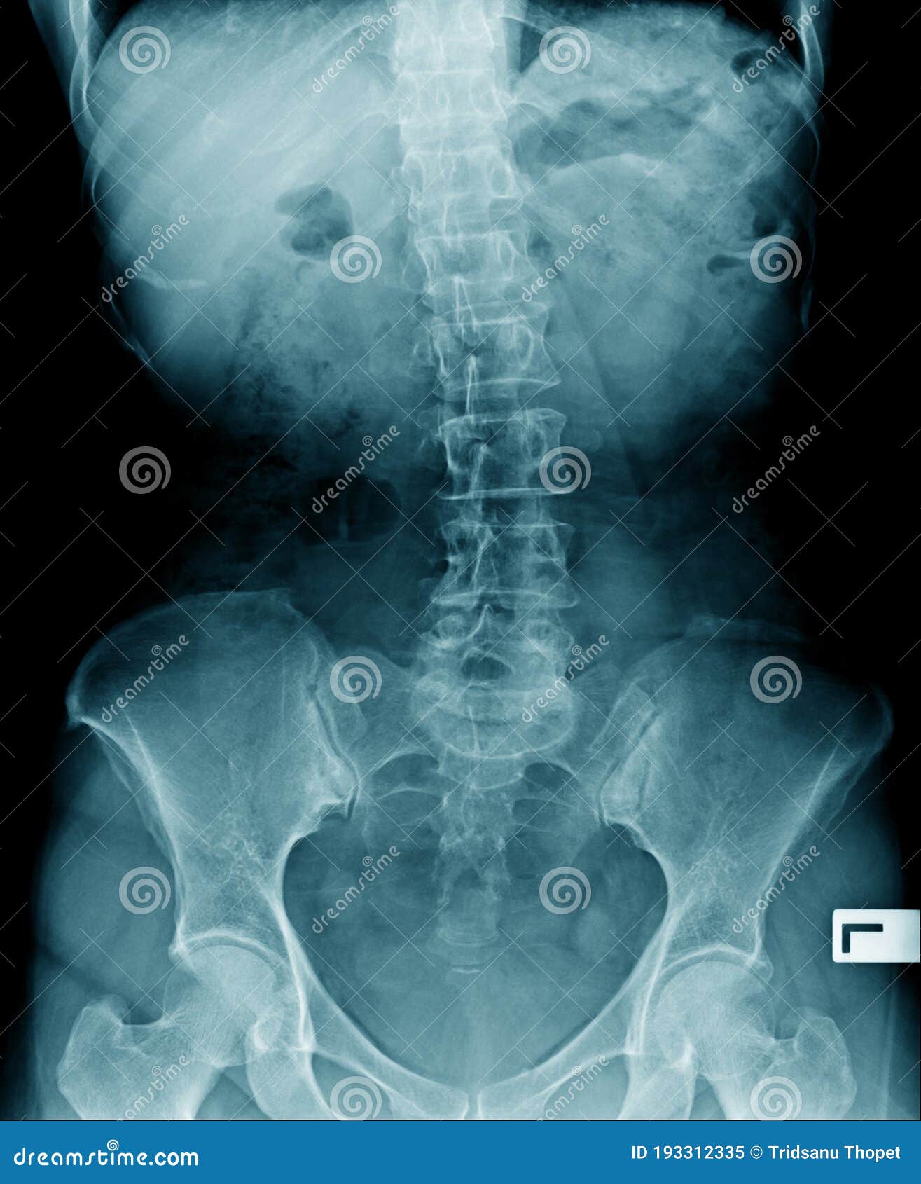 X-ray image of human spine stock image. Image of back - 193312335