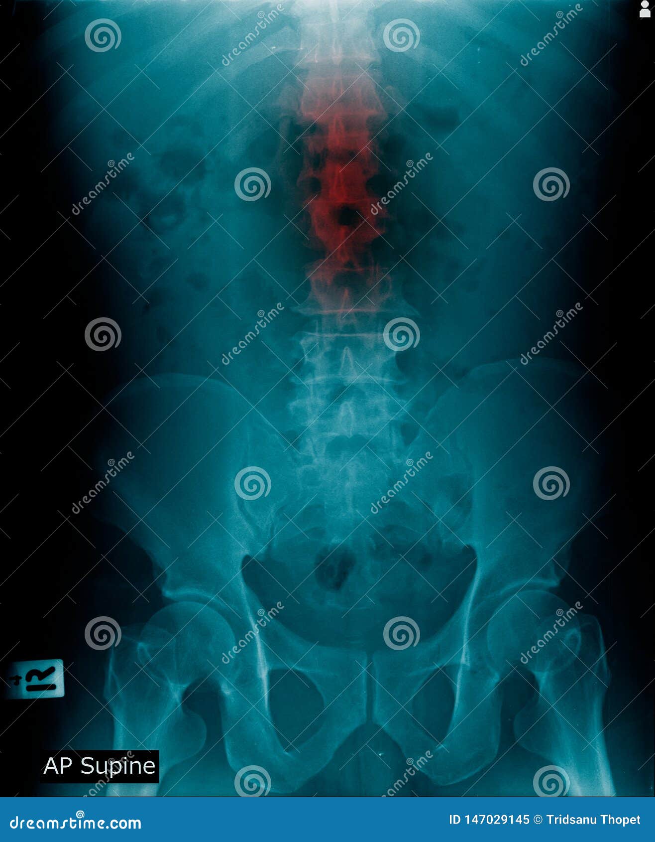 X-ray image of human spine stock image. Image of health - 147029145