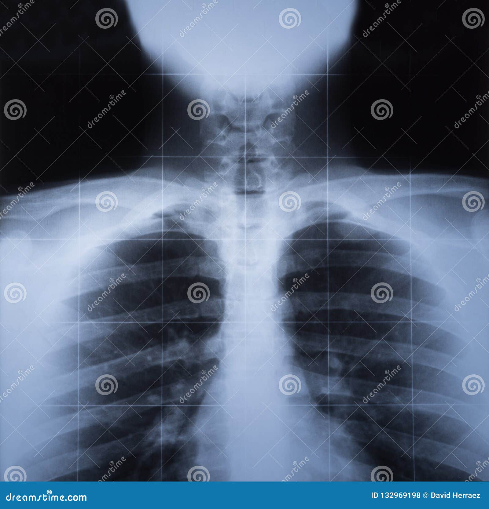 X Ray Image of Human Thorax Stock Photo - Image of checkup, clinic ...