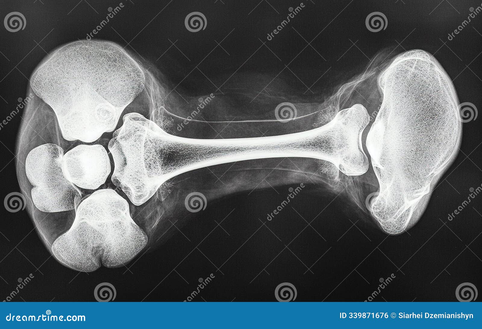 X-ray Image of a Human Upper Arm Showing the Humerus and Associated ...