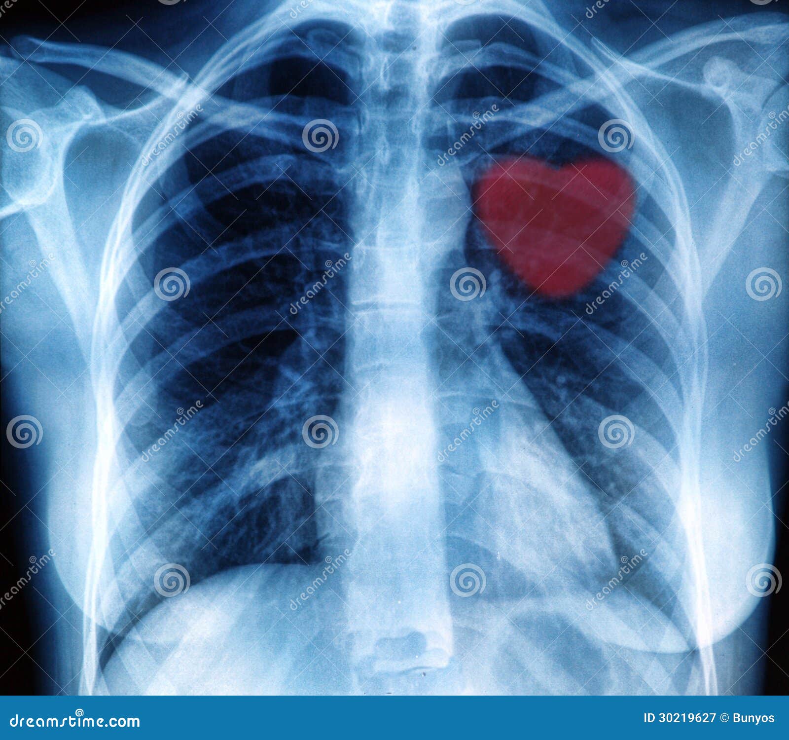 Chest X-ray image stock image. Image of heart, cardiovascular - 30219627