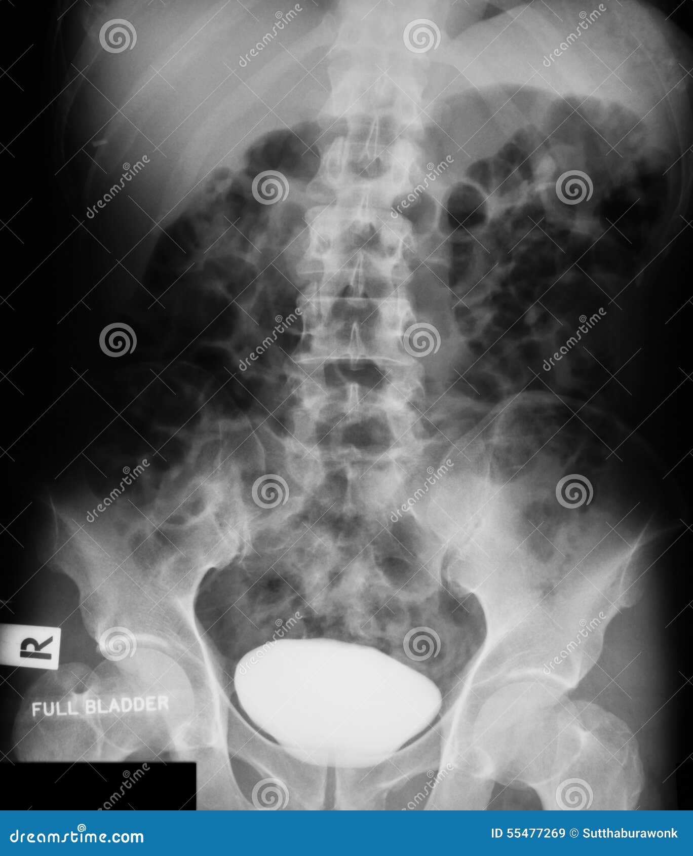 IVP Pyelogram Of Patient With Kidney Stone Stock Image | CartoonDealer ...