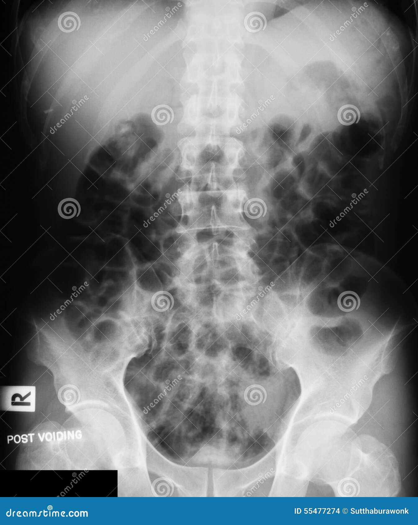 X-ray Image of IVP, Supine View. Stock Photo - Image of diagnosis ...
