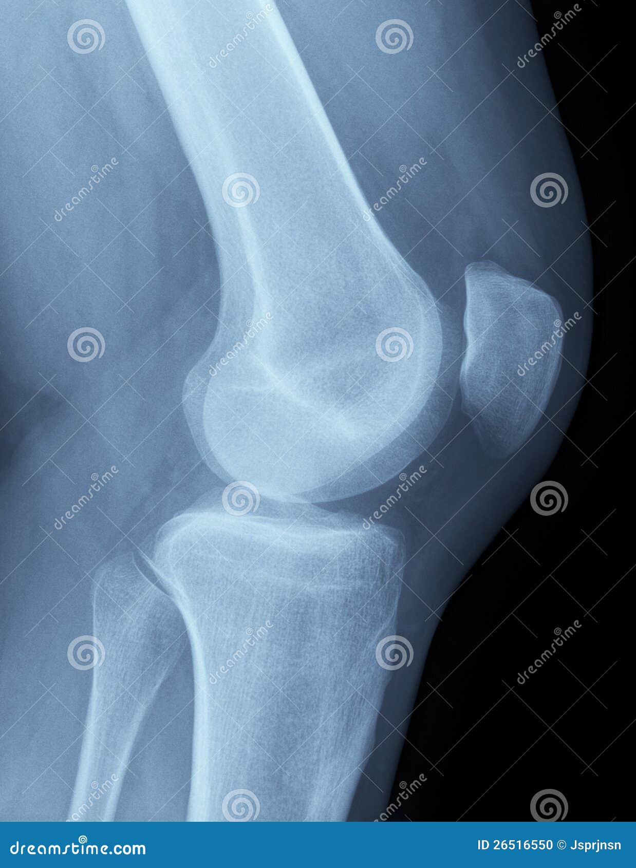 X-Ray image of a knee stock photo. Image of athlete, bones - 26516550