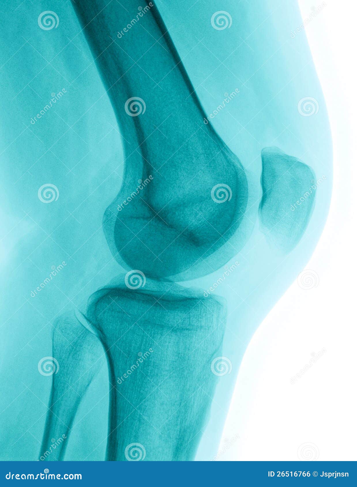 X-Ray image of a knee stock photo. Image of body, endoskeleton - 26516766