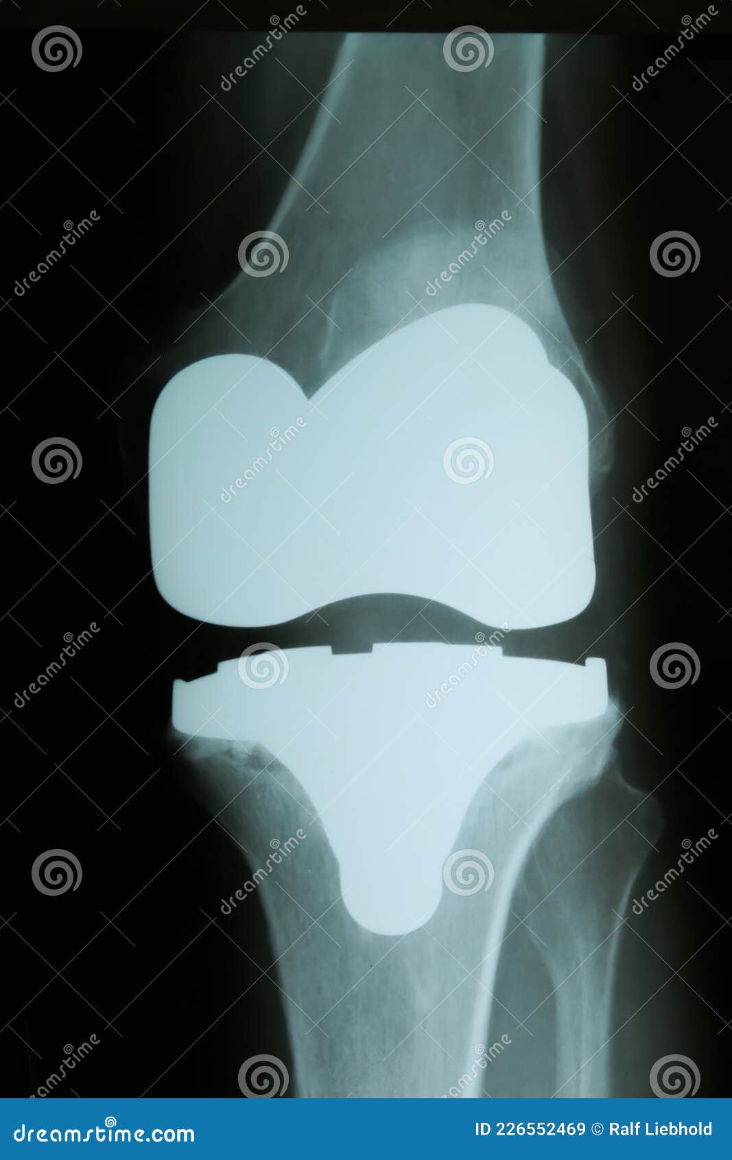 X-Ray Image of Knee with Complete Artificial Joint Replacement ...