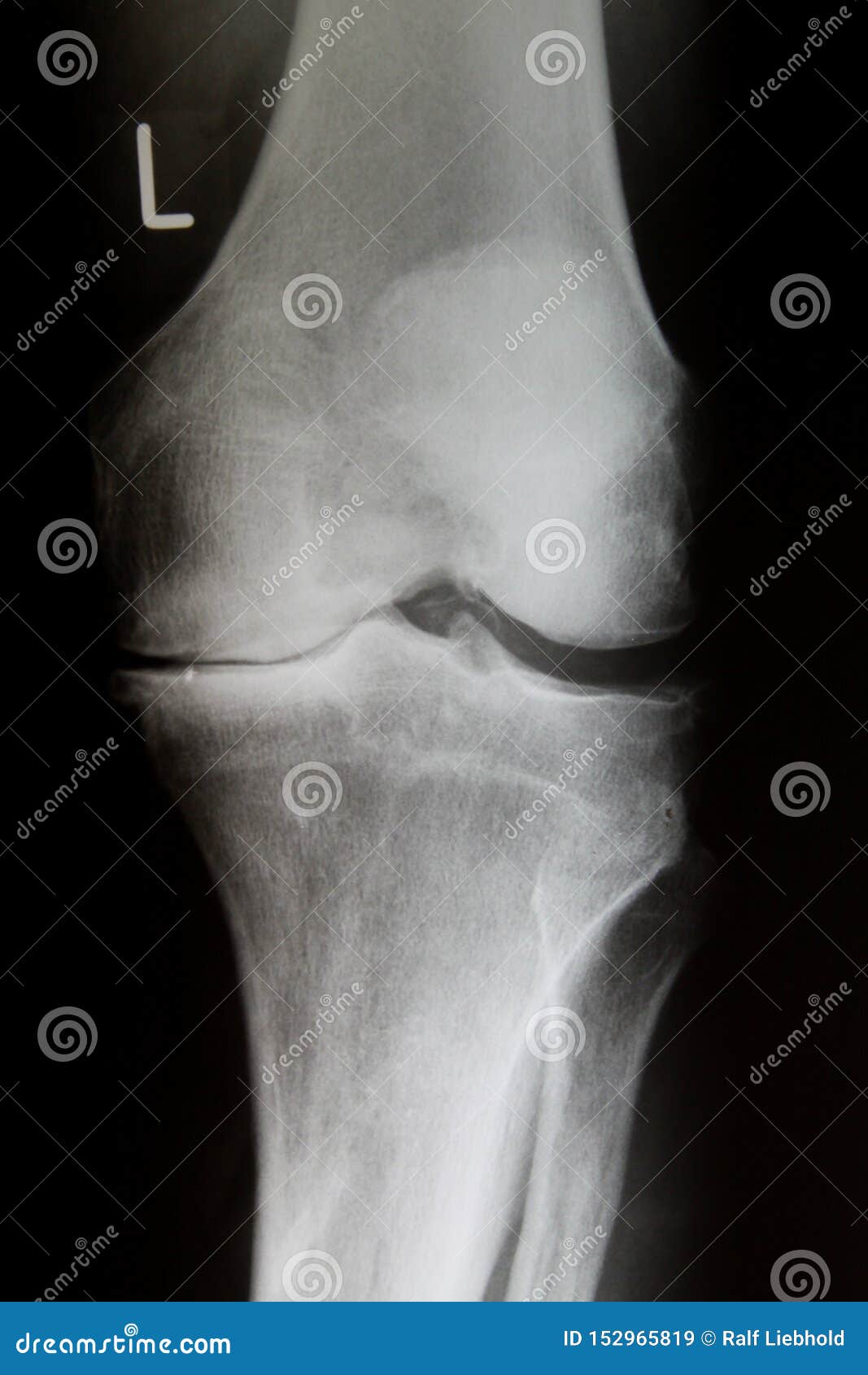X-Ray Image of Knee Joint with Advanced Arthrosis Gonarthrose Stock ...